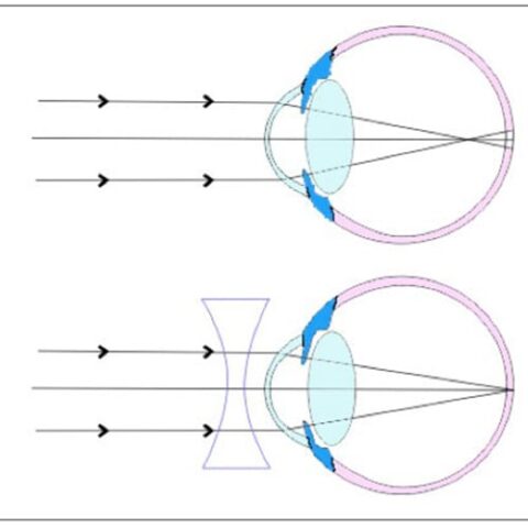 Myopie : définition, causes et symptômes - Dr Jean-Marc Ancel