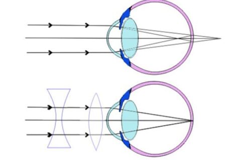 Astigmatisme : définition, symptômes, traitement - Docteur Ancel